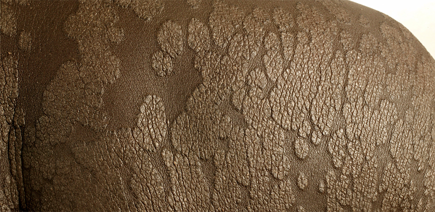 Psoriasis Pictures | psoriasisSPEAKS