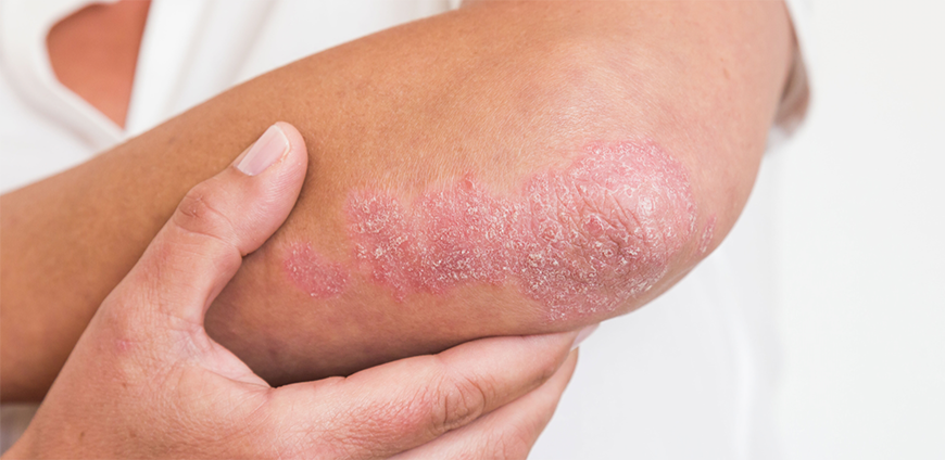Psoriasis Pictures | psoriasisSPEAKS
