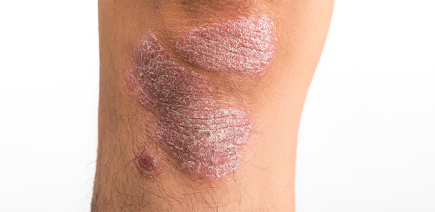 Psoriasis Pictures | psoriasisSPEAKS