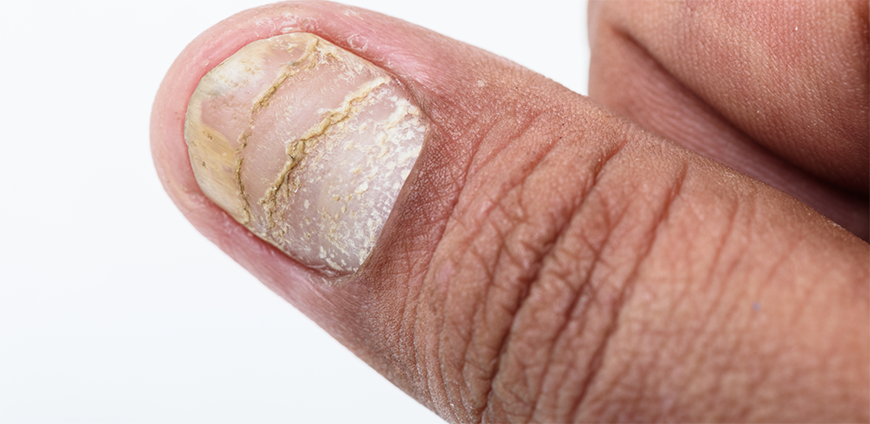 Psoriasis Pictures | psoriasisSPEAKS