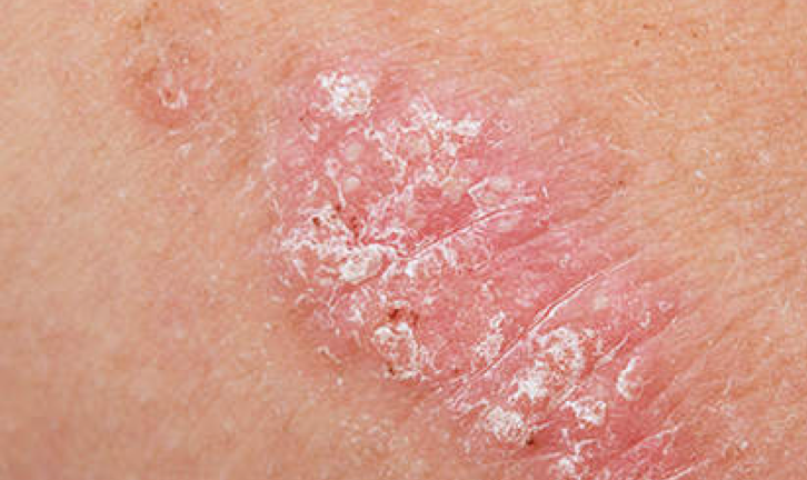 What Is Psoriasis? | psoriasisSPEAKS